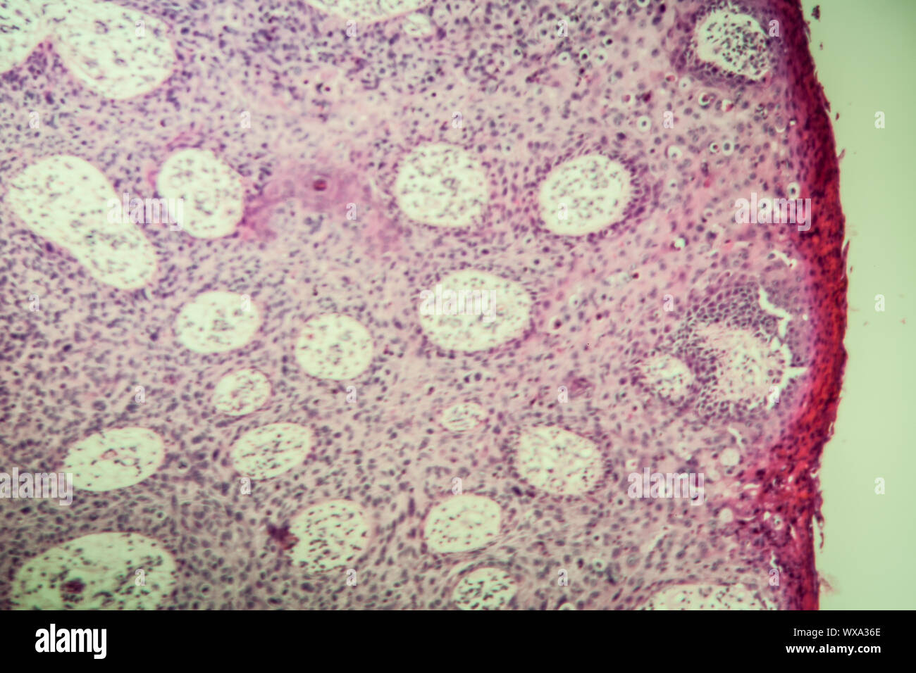 Bowen's Disease Sick tissue under the microscope 100x Stock Photo - Alamy