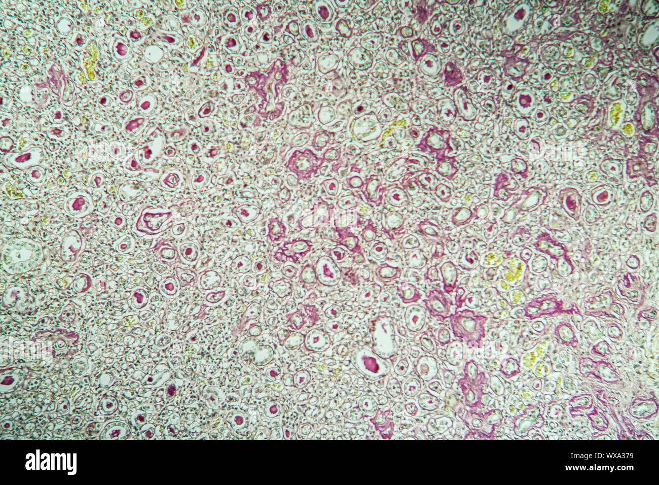 Shrink kidney diseased tissue under the microscope 100x Stock Photo - Alamy