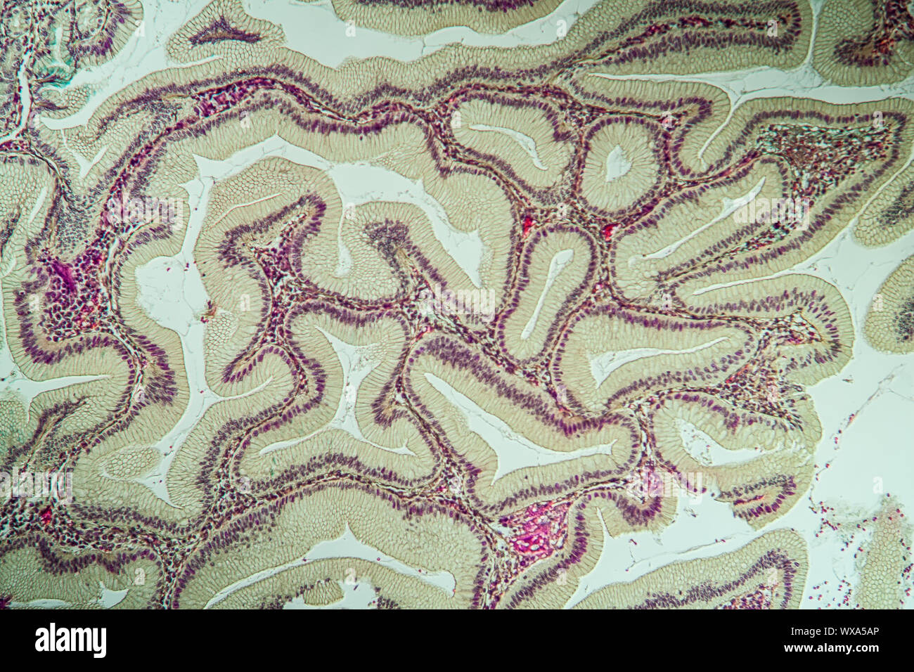 Mecklische diverticulum with ulceration diseased tissue under the ...