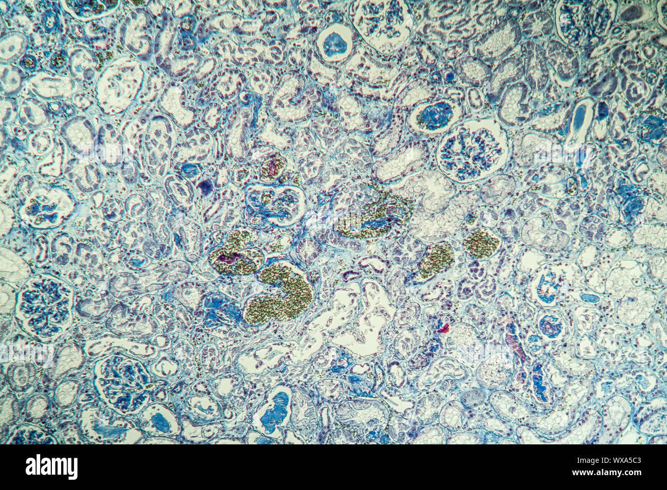 Kidney Disease Fibrin deposits in the kidney, 100x Stock Photo - Alamy