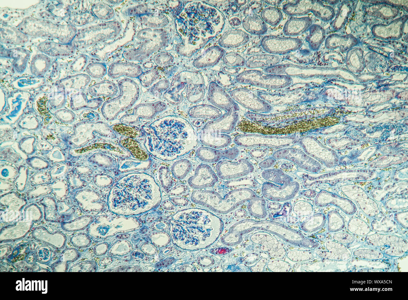 Kidney Disease Fibrin deposits in the kidney, 100x Stock Photo - Alamy