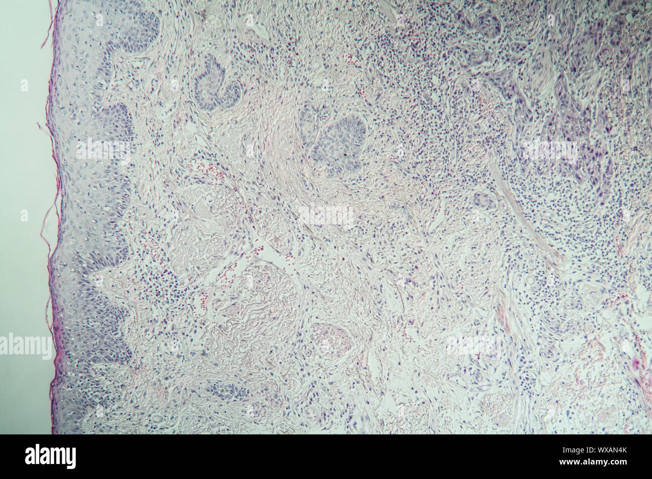 Lips carcinoma under the microscope 100x Stock Photo - Alamy