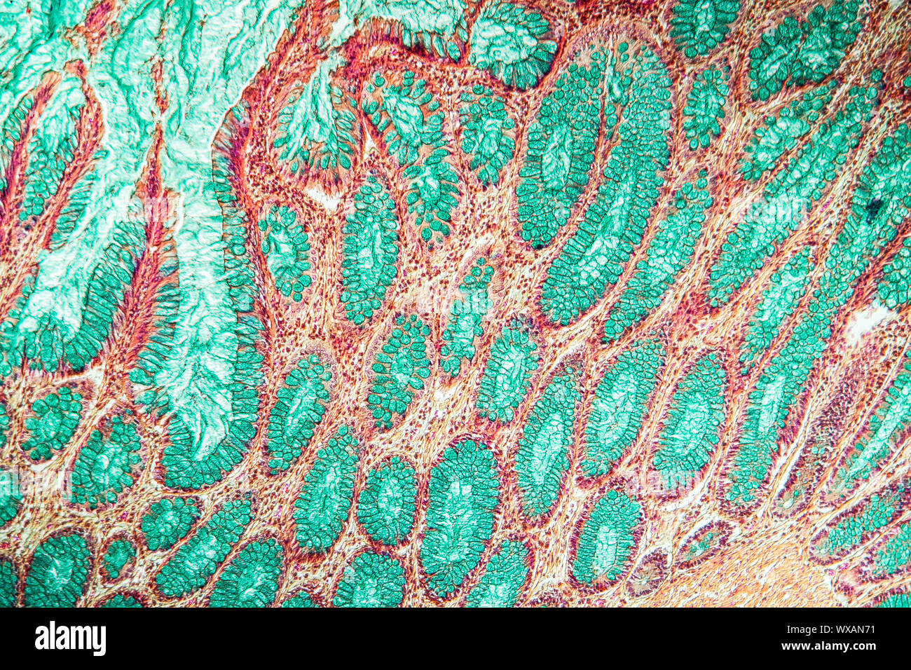 Colon cancer tissue section under the microscope 100x Stock Photo - Alamy