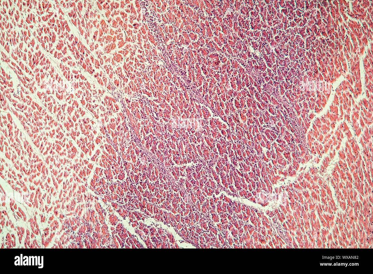 Heart attack tissue section hi-res stock photography and images - Alamy