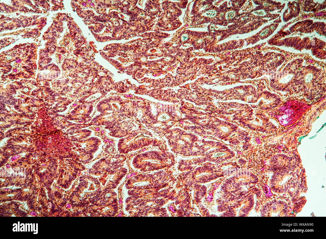 Colon cancer tissue section under the microscope 100x Stock Photo - Alamy