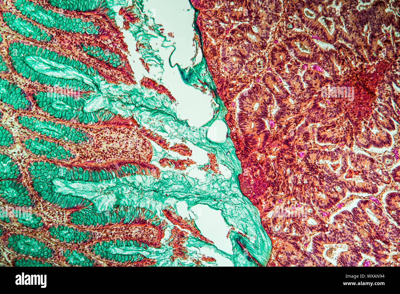 Cancer microscope hi-res stock photography and images - Alamy