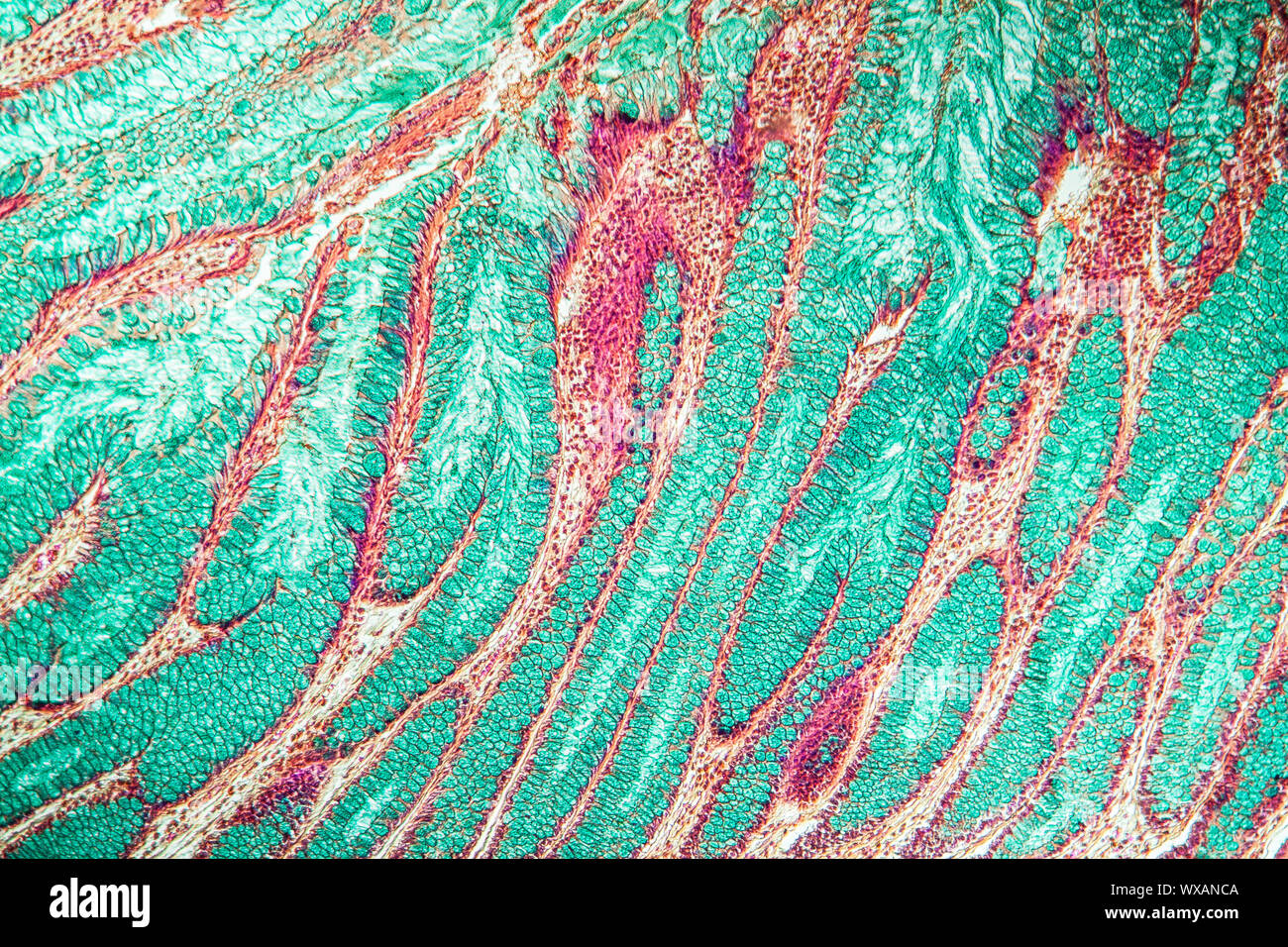 Colon cancer tissue section under the microscope 100x Stock Photo - Alamy