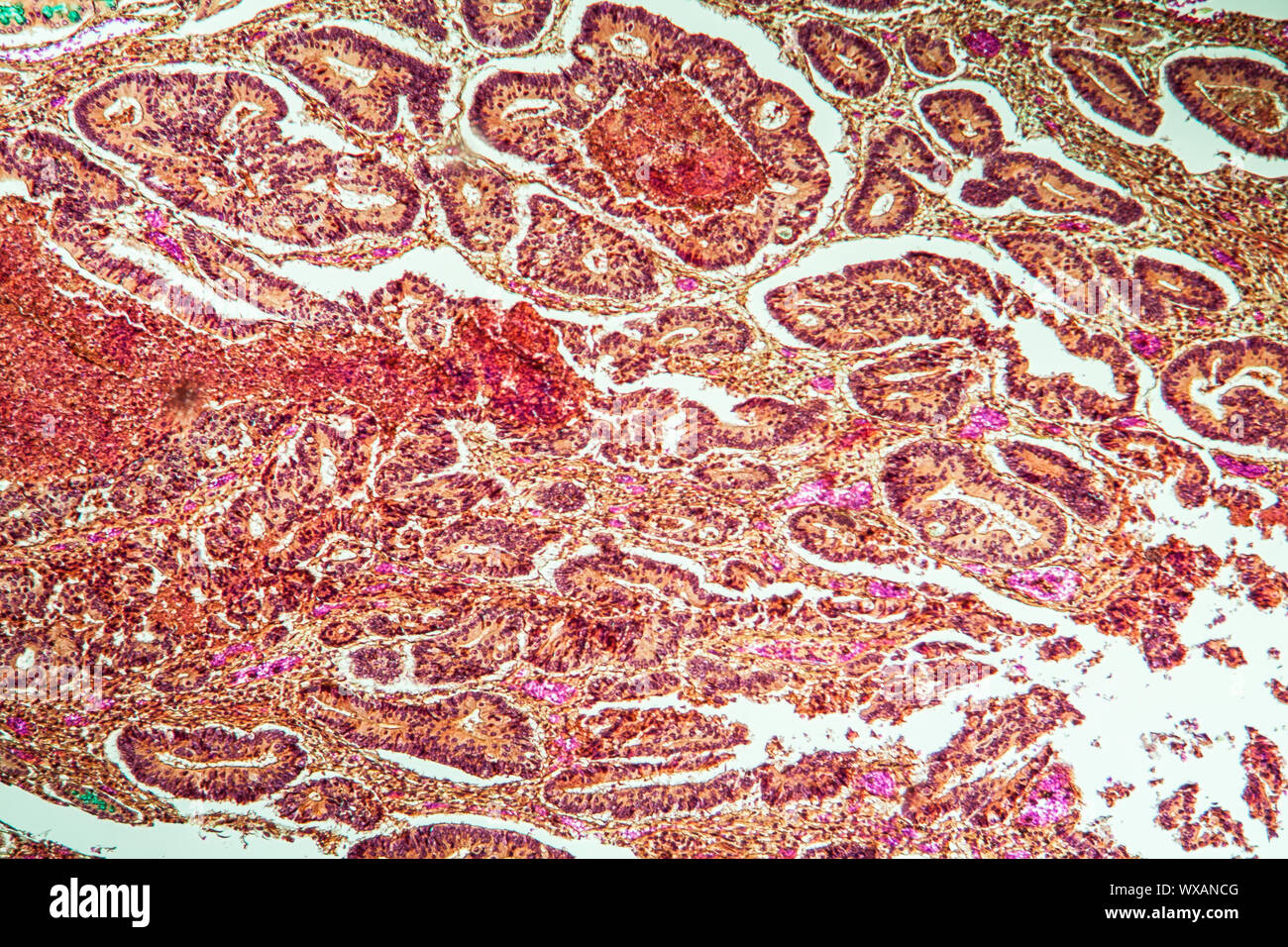 Colon cancer tissue section under the microscope 100x Stock Photo - Alamy