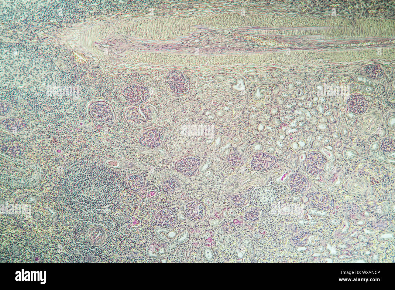 Hydronephrosis hi-res stock photography and images - Alamy