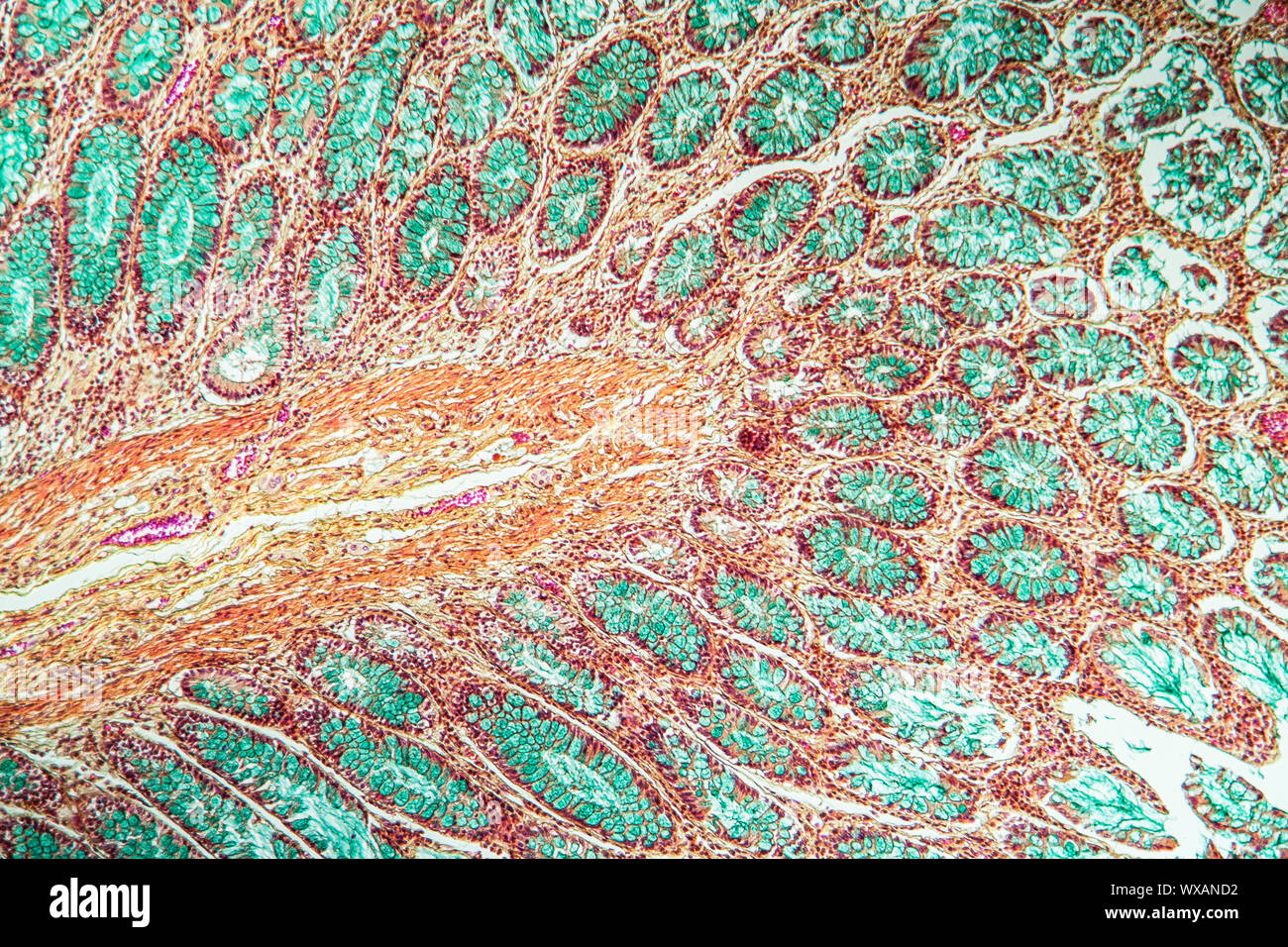 Cancer cells bowel hi-res stock photography and images - Alamy