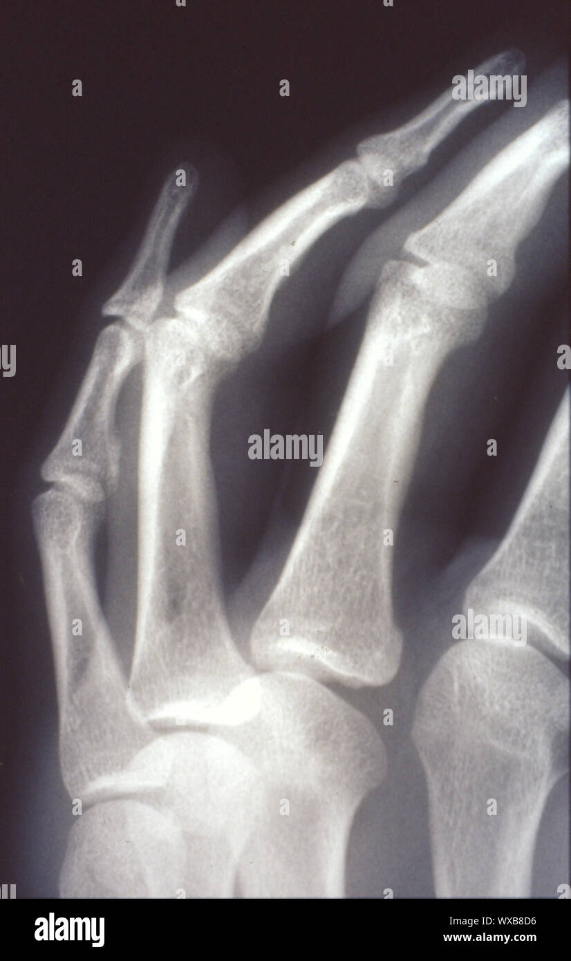 Hand bone fracture hi-res stock photography and images - Alamy