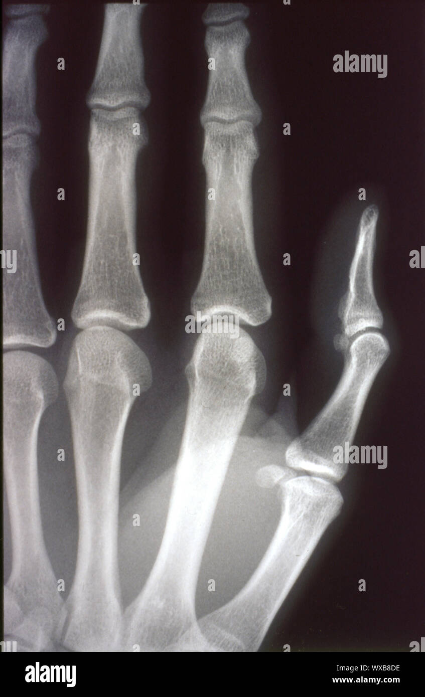 X-ray picture, man, hand Stock Photo - Alamy