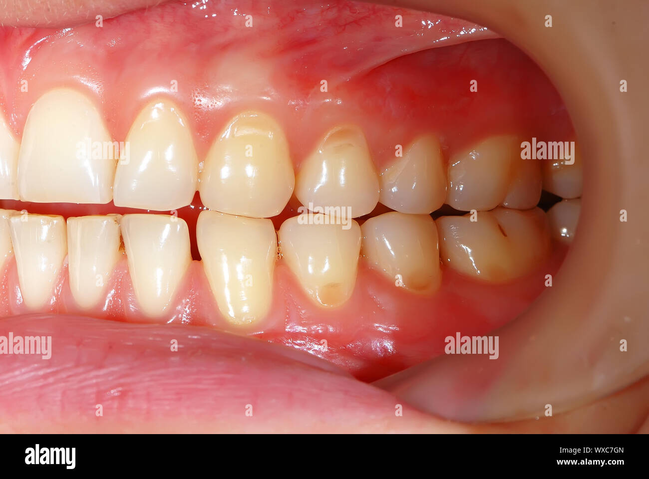 high resolution human teeth, closeup Stock Photo - Alamy