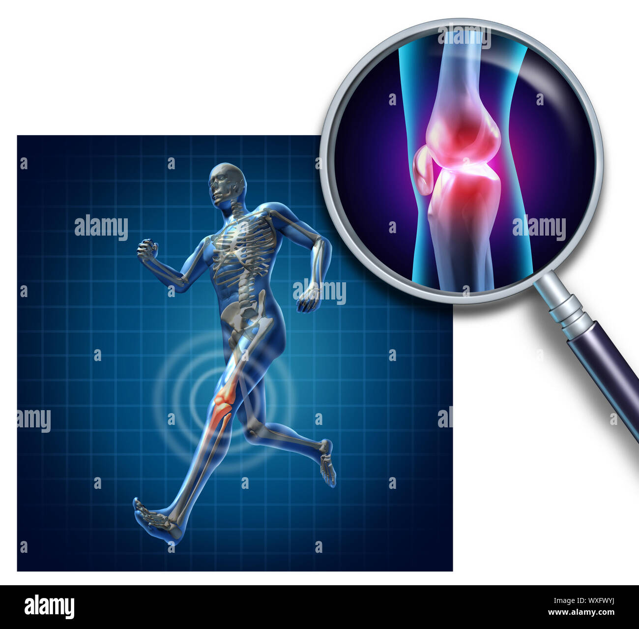 Sports knee injury with a running athlete showing the anatomical ...