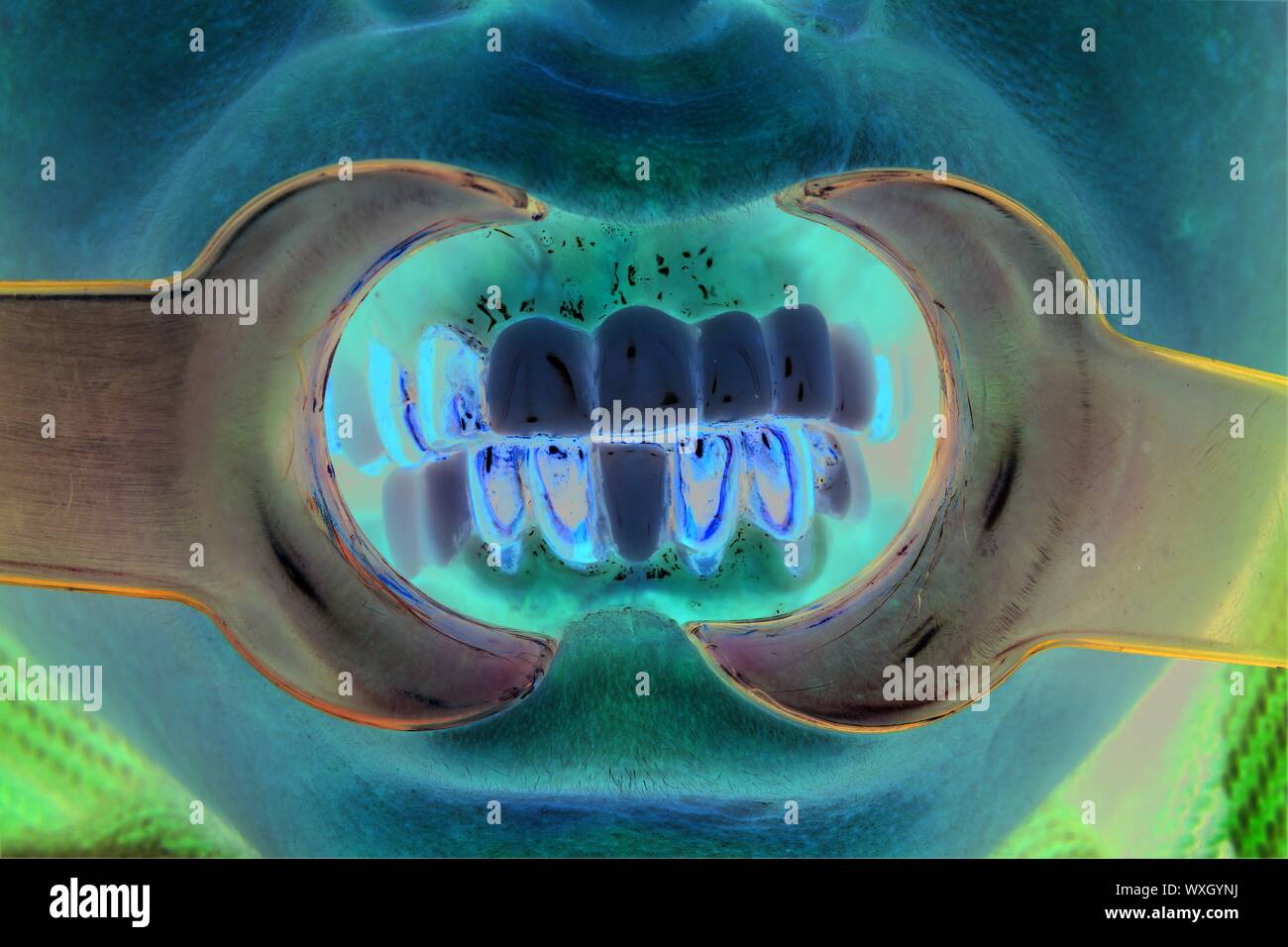 bad dental crowns close-up in person’s mouth at the dentist’s ...