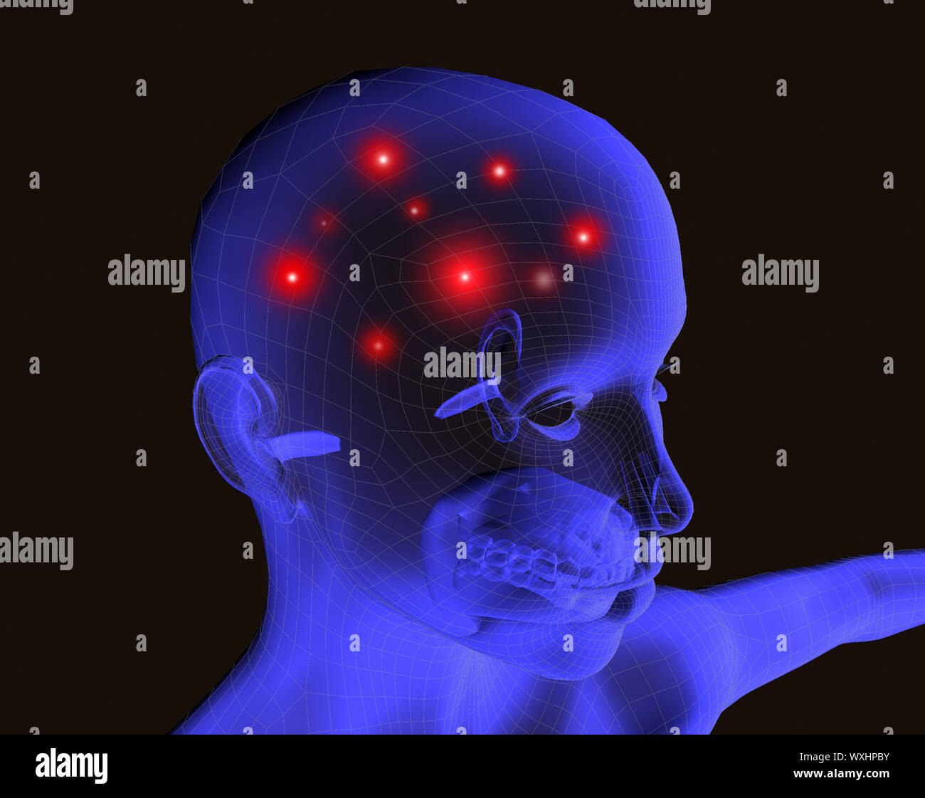 Inflammation of brain hi-res stock photography and images - Alamy