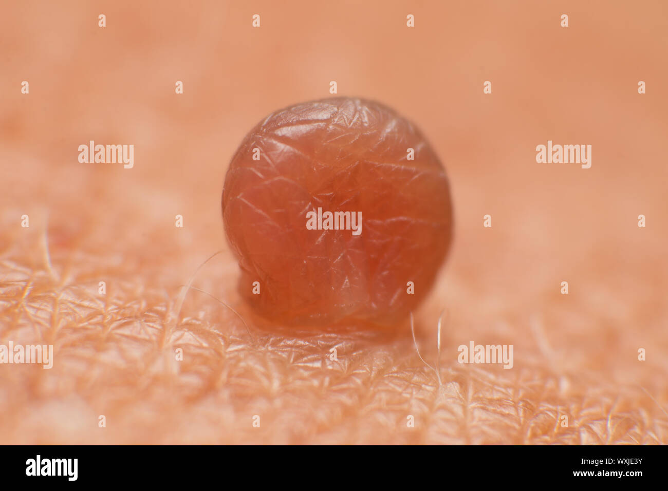 Mole on the skin of the body. Birthmark. Acrochordon Stock Photo - Alamy