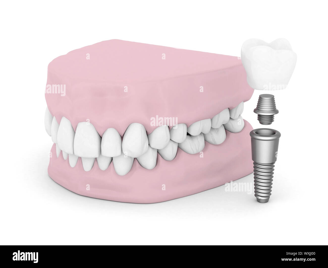 Dental implants isolated on white background Stock Photo - Alamy
