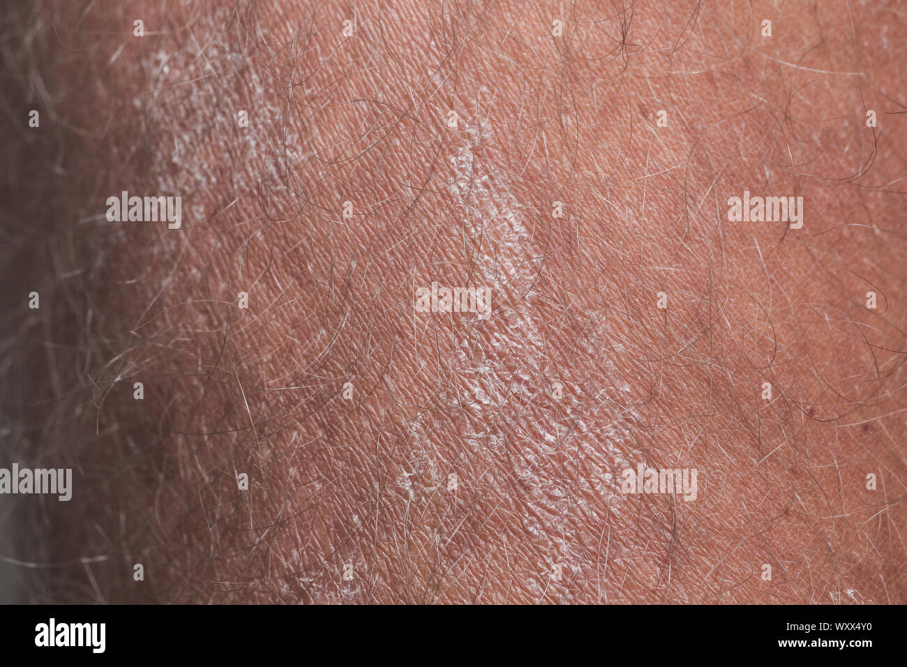 Large plaque parapsoriasis on caucasian man legs Stock Photo - Alamy