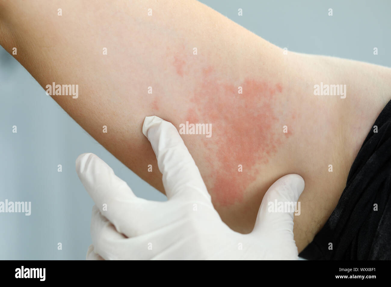Allergic rush inspection Stock Photo - Alamy