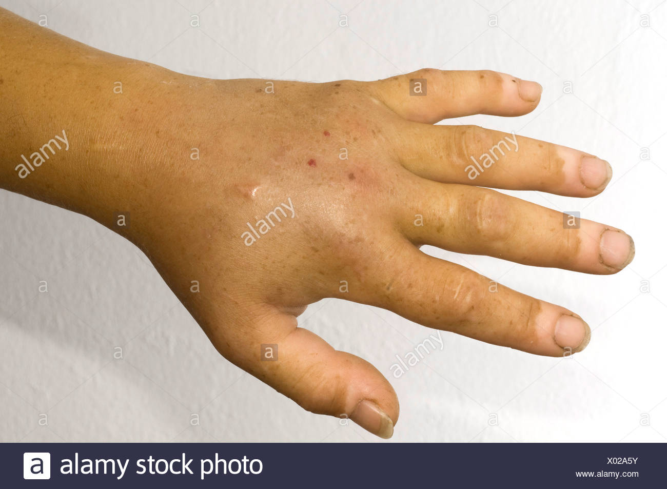 Bites Of Venomous Snakes High Resolution Stock Photography and Images ...