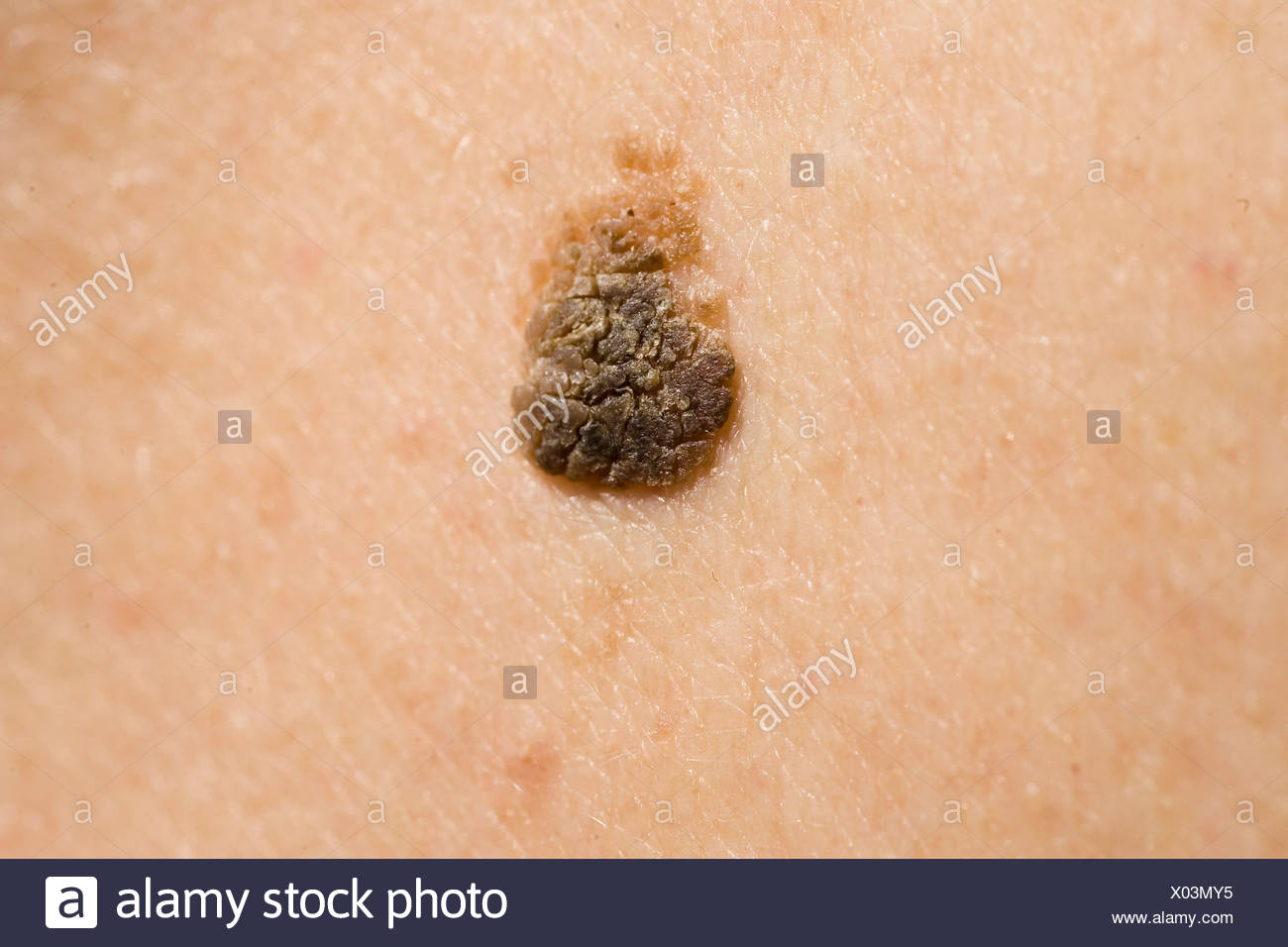 Verruca Stock Photos & Verruca Stock Images - Alamy