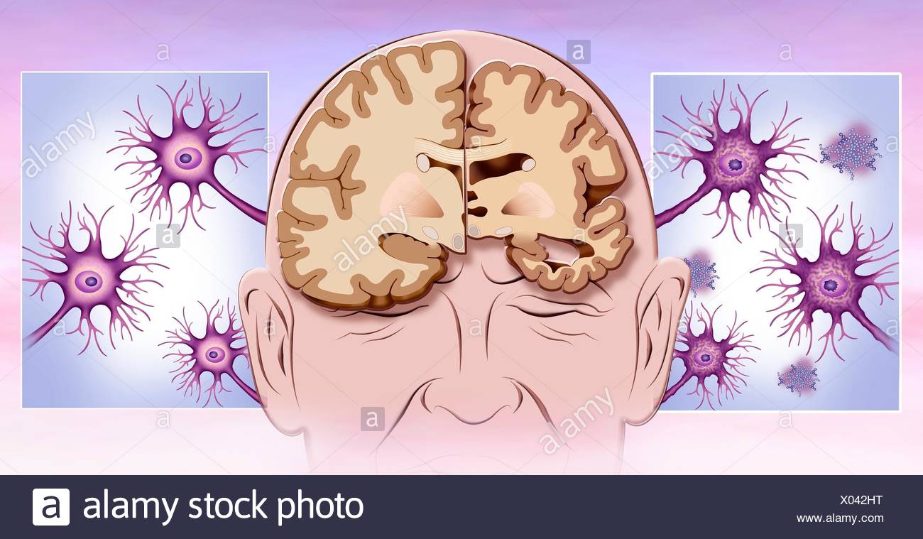 Brain Atrophy Stock Photos & Brain Atrophy Stock Images - Alamy