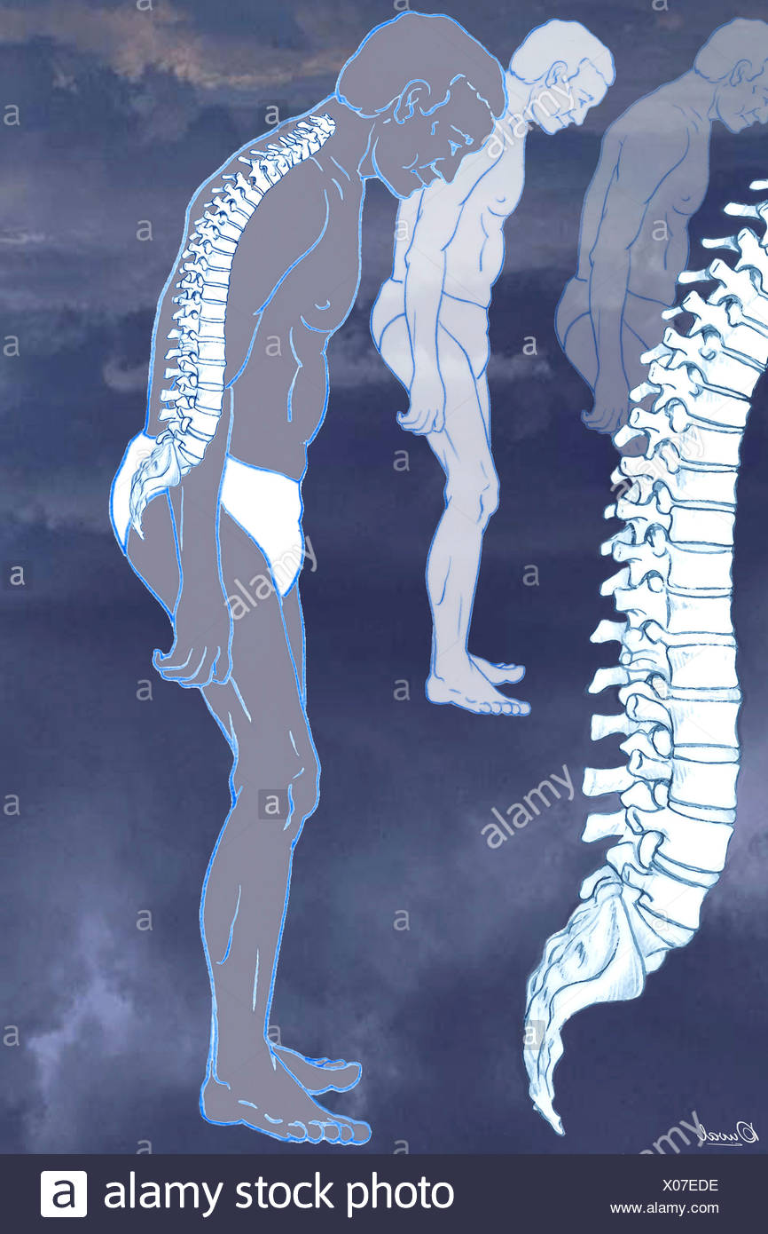 Ankylosing Spondylitis High Resolution Stock Photography and Images - Alamy