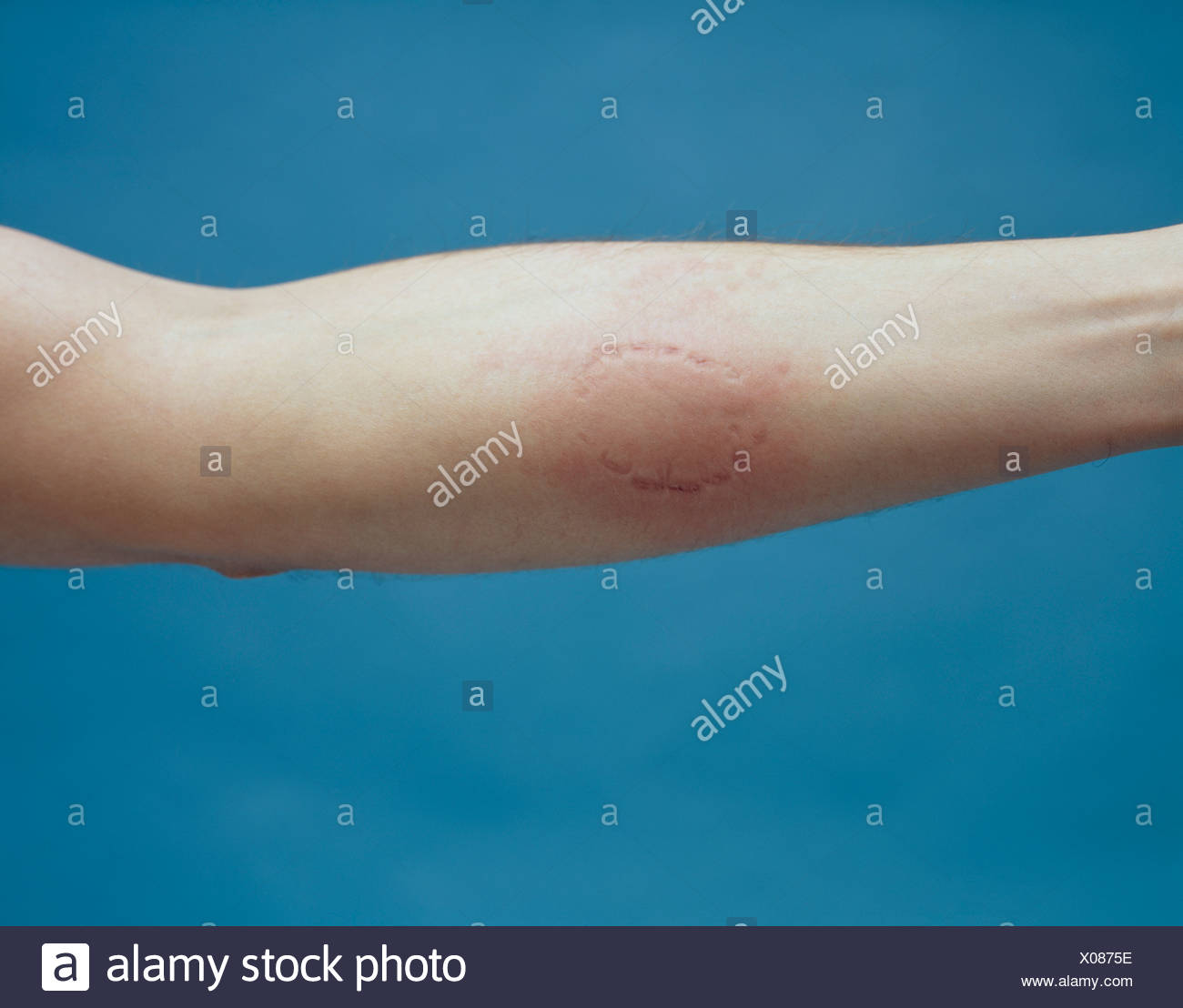 Human Bite: Causes, Symptoms, Risks, And Treatment, 46% OFF Human Bite: Causes, Symptoms, Risks, And Treatment, 46% OFF