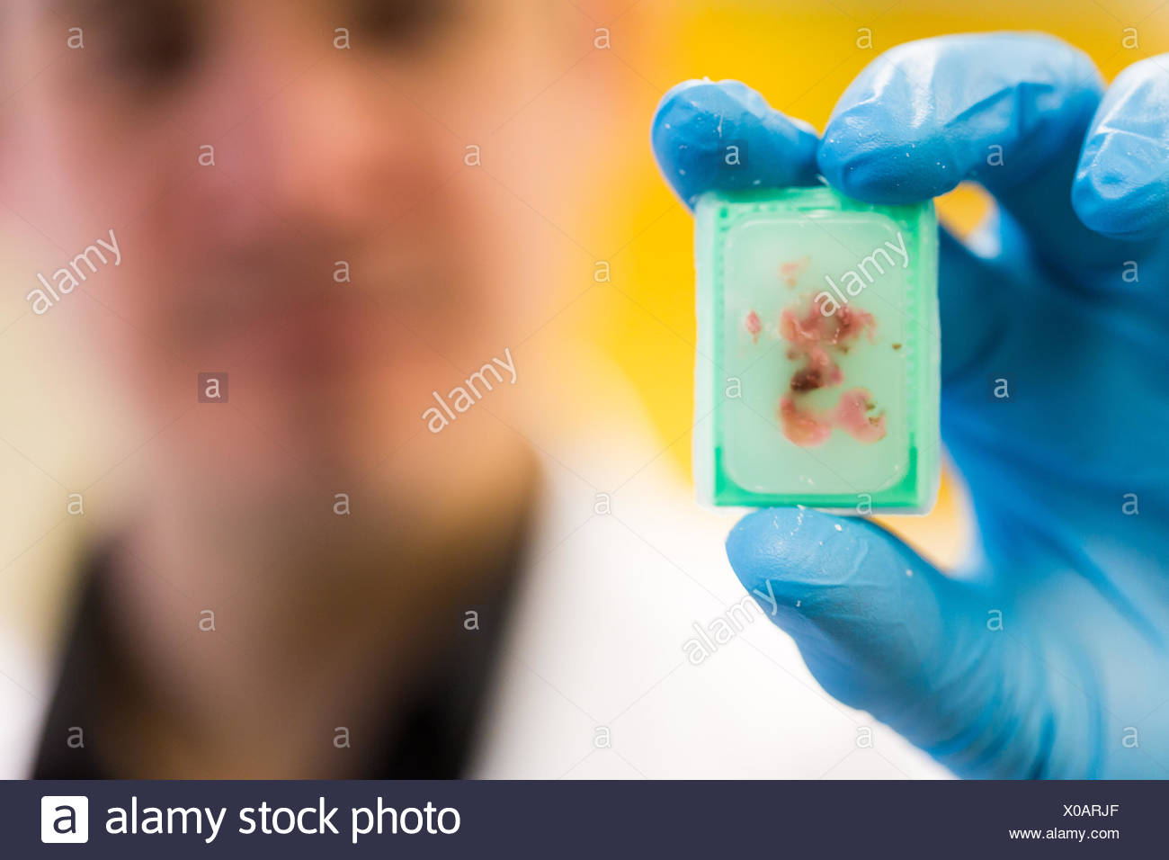 Tumor Sample Taken From Patients High Resolution Stock Photography and ...