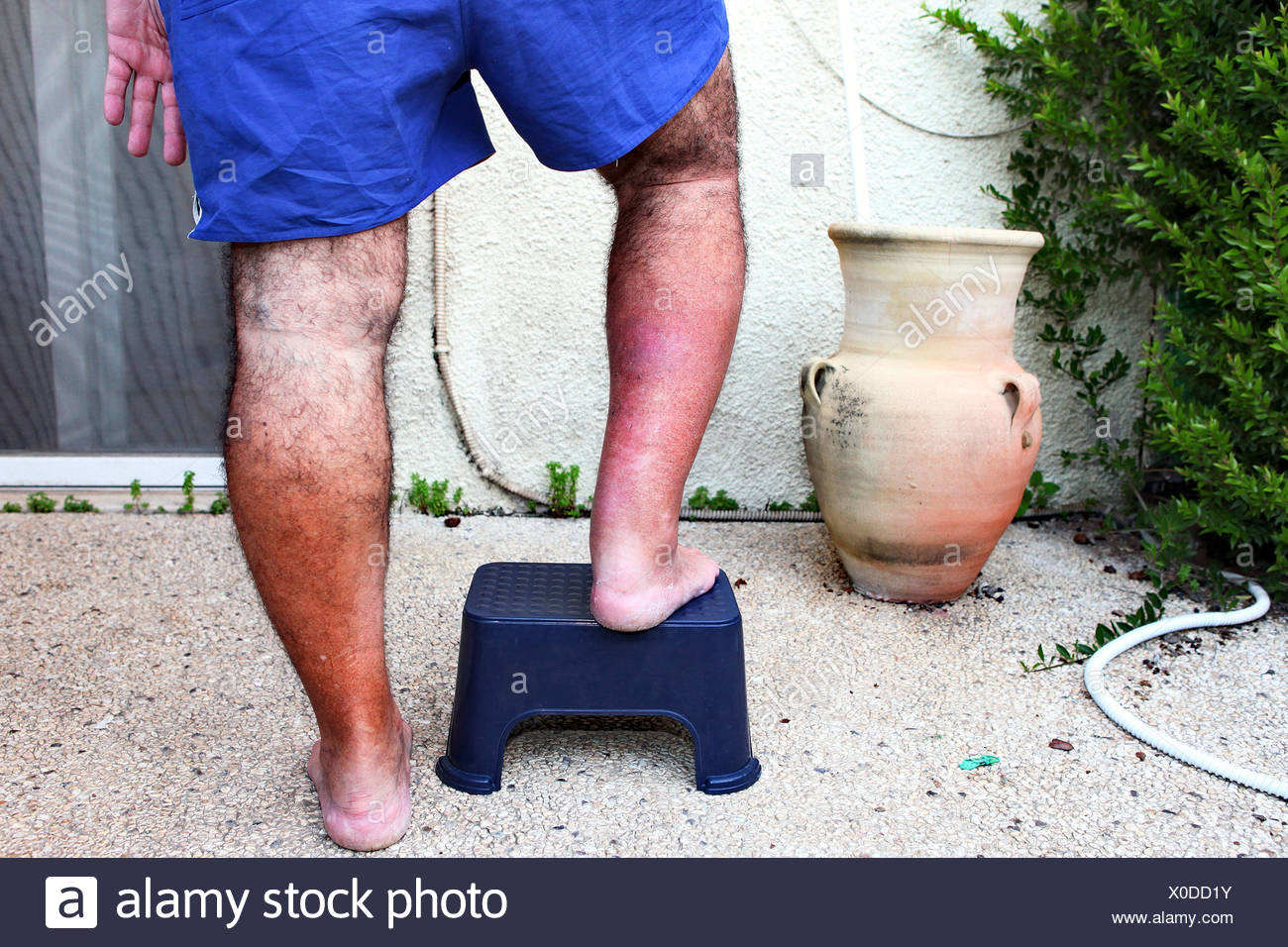 Rash Leg High Resolution Stock Photography and Images - Alamy
