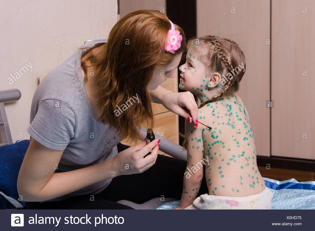 Weeping Skin High Resolution Stock Photography and Images - Alamy