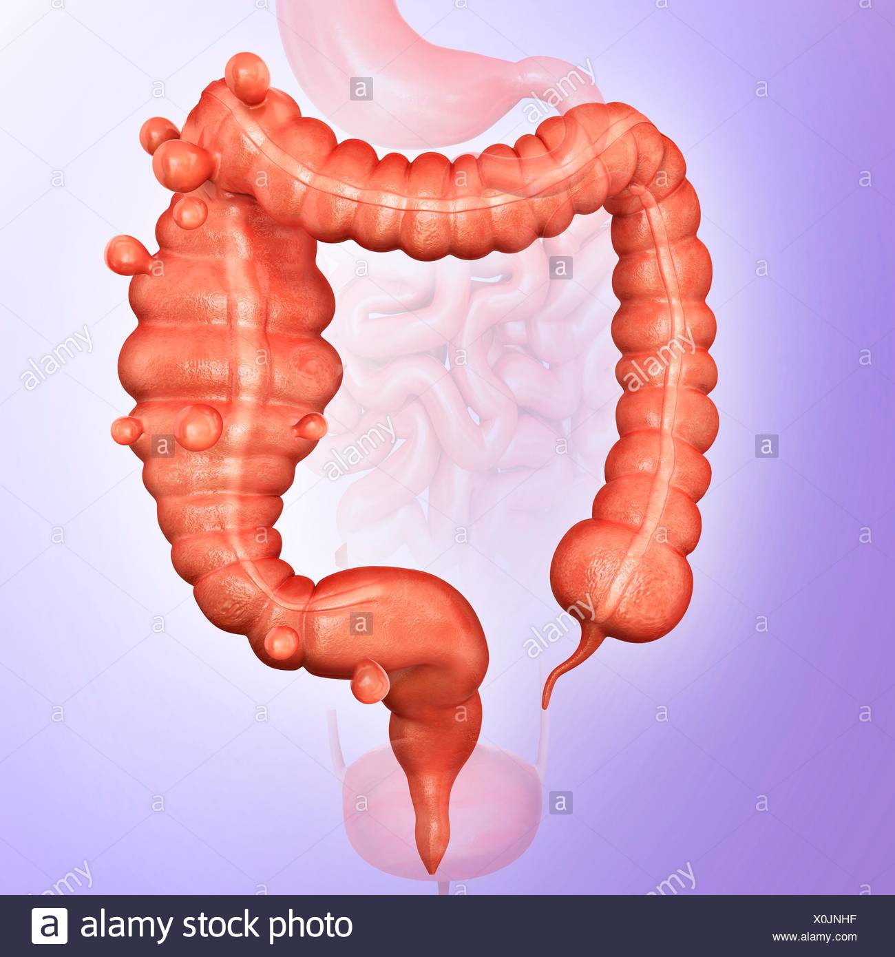 Diverticulosis Of Colon Stock Photos & Diverticulosis Of Colon Stock ...