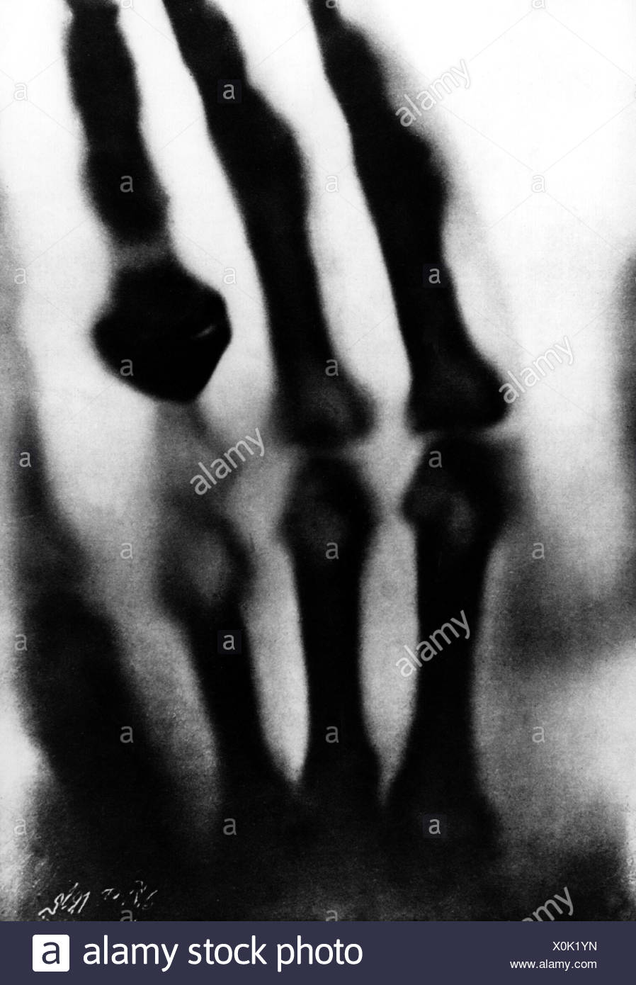 Roentgen Hand X Ray High Resolution Stock Photography and Images - Alamy