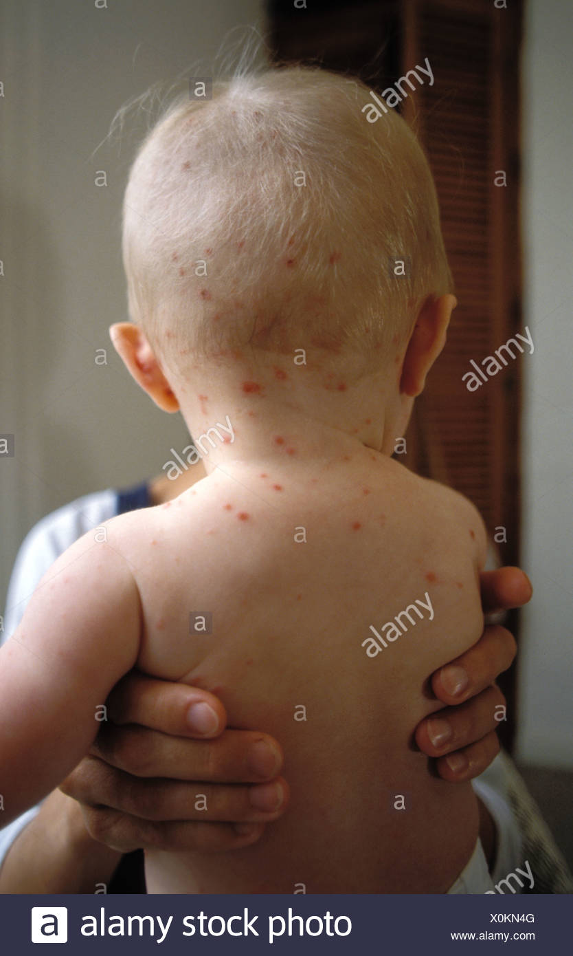 Baby With Chickenpox High Resolution Stock Photography and Images - Alamy