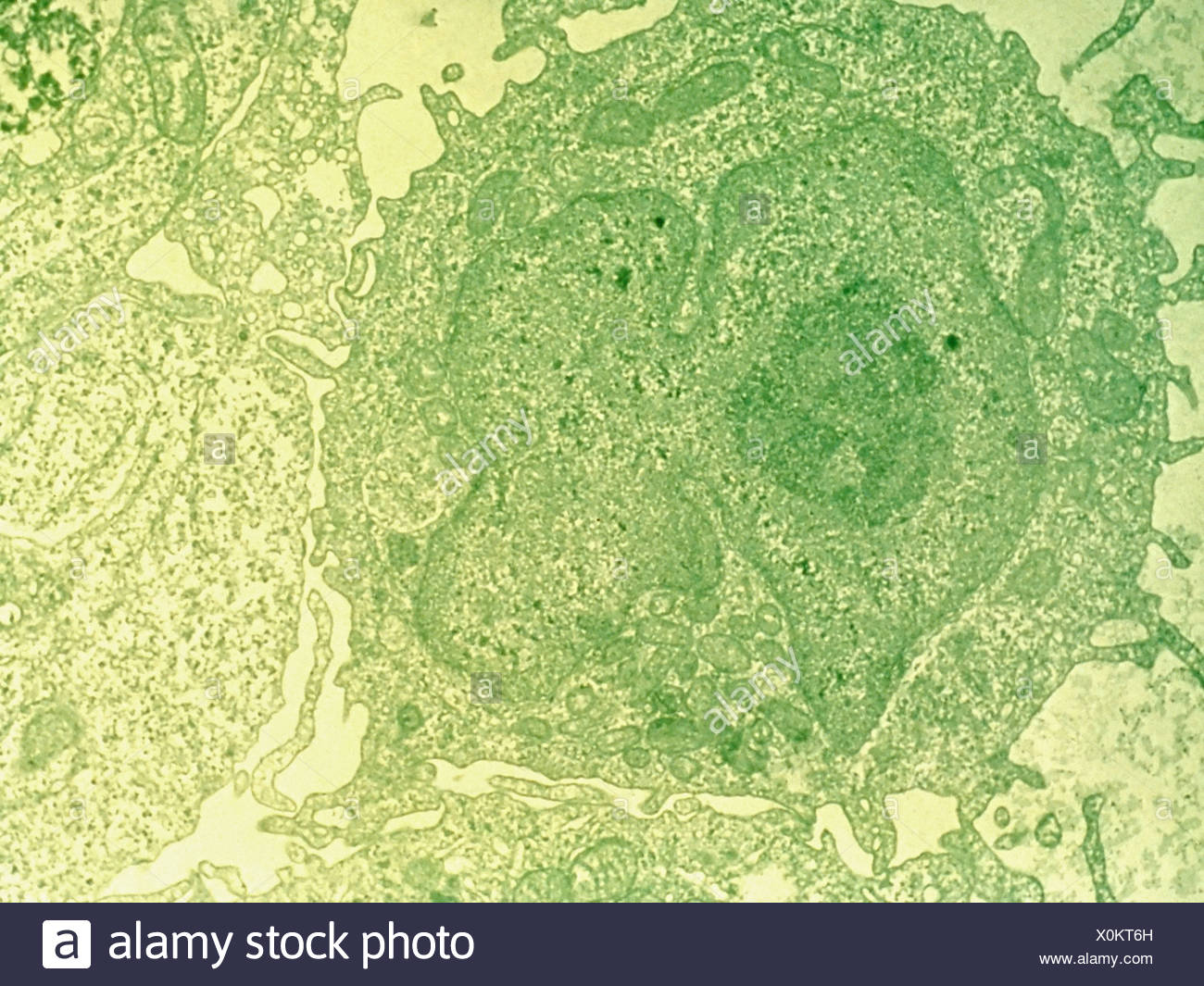 Hairy Cell Leukemia High Resolution Stock Photography and Images - Alamy
