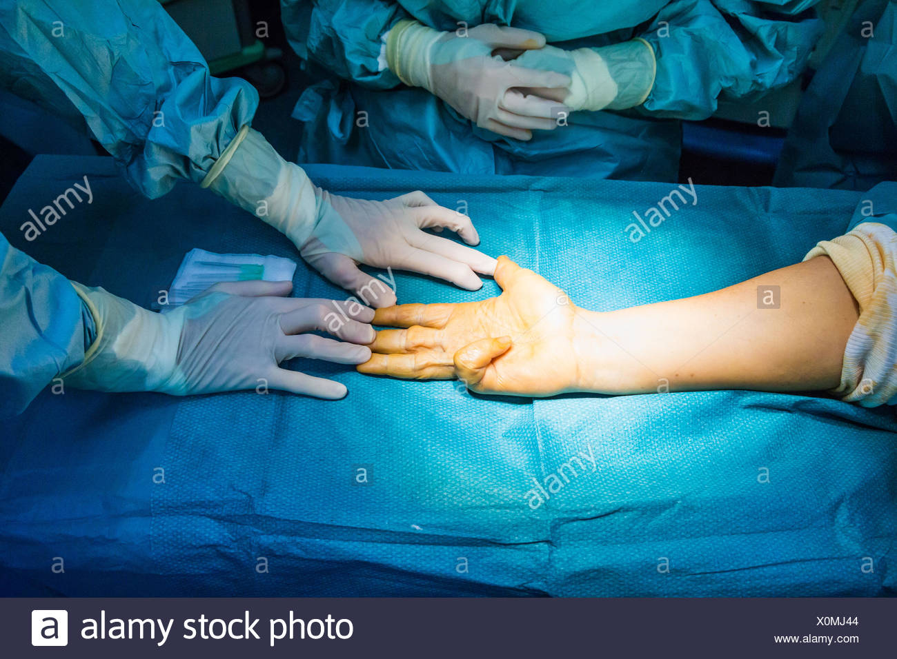 Dupuytrens Contracture Hand Surgery High Resolution Stock Photography ...