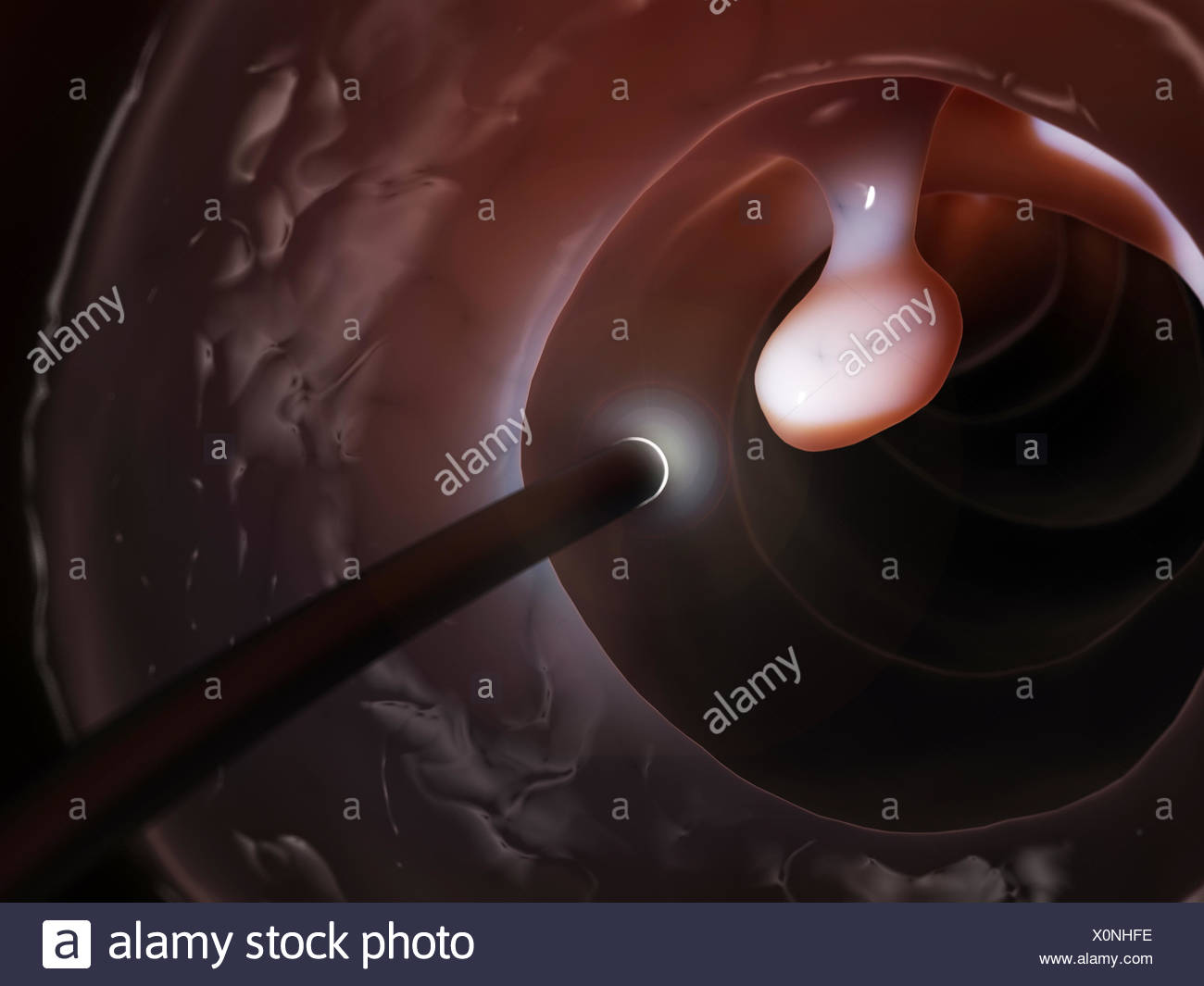 Ct Of Colon High Resolution Stock Photography and Images - Alamy