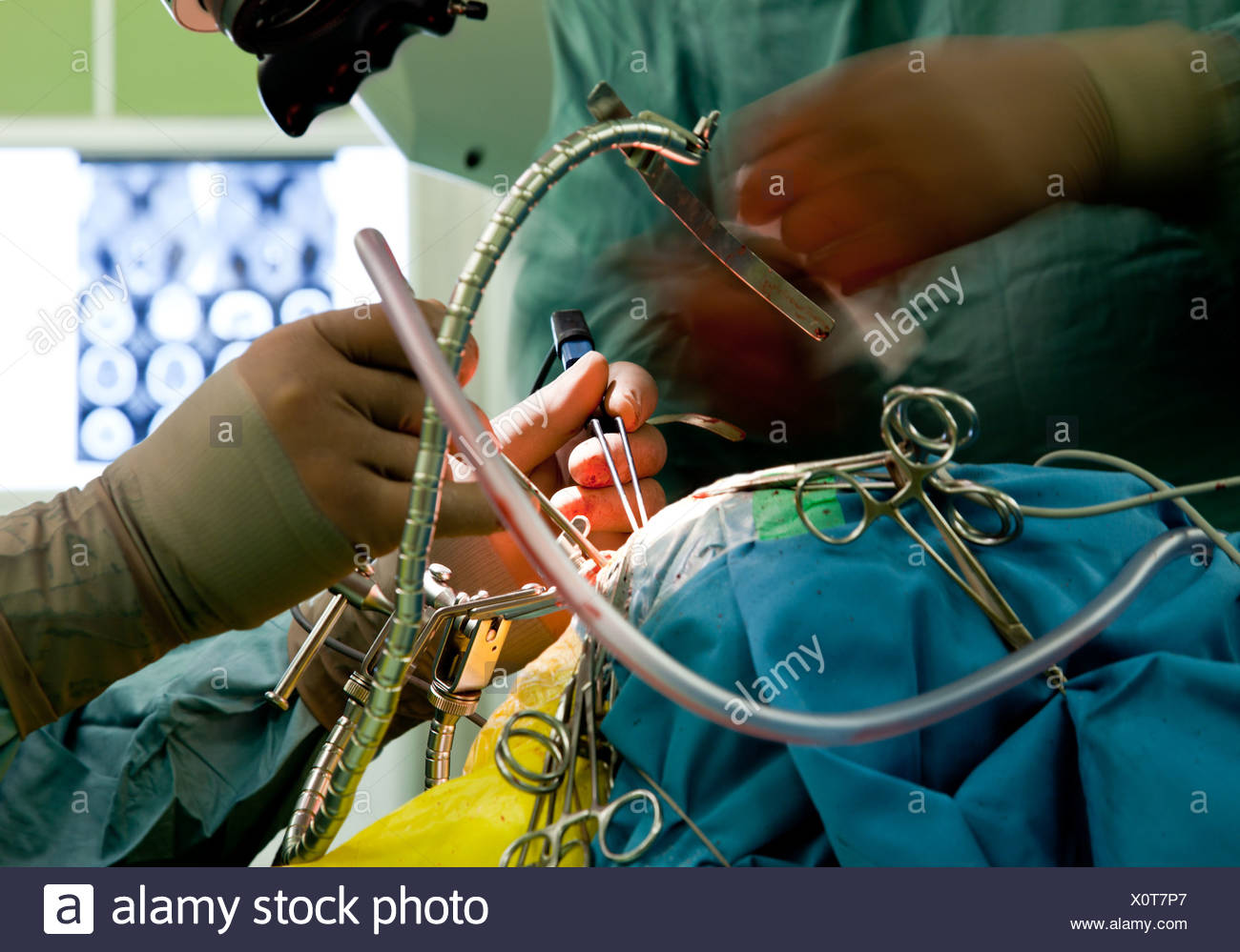 Brain Surgery High Resolution Stock Photography and Images - Alamy