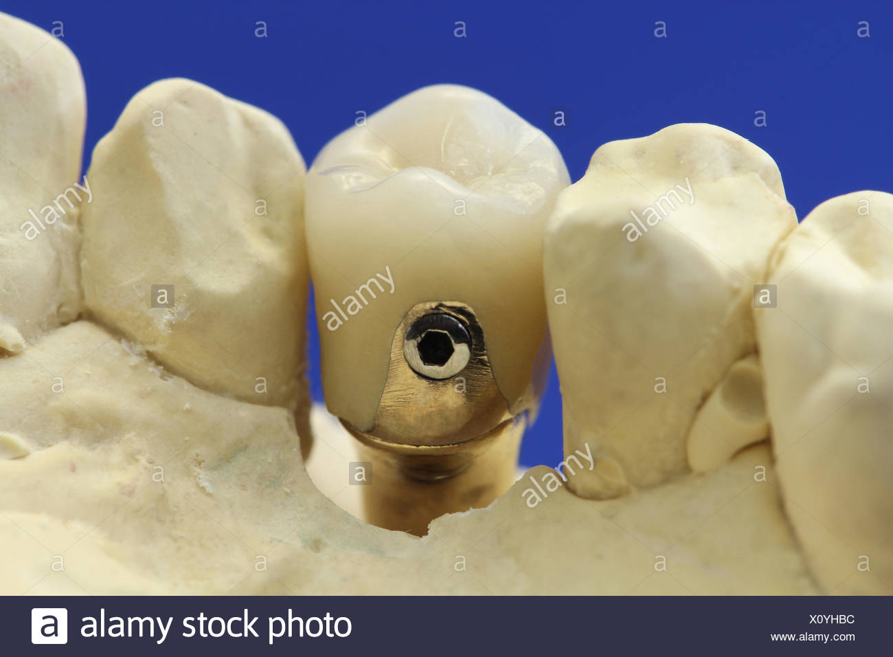 Implant Screw High Resolution Stock Photography and Images - Alamy