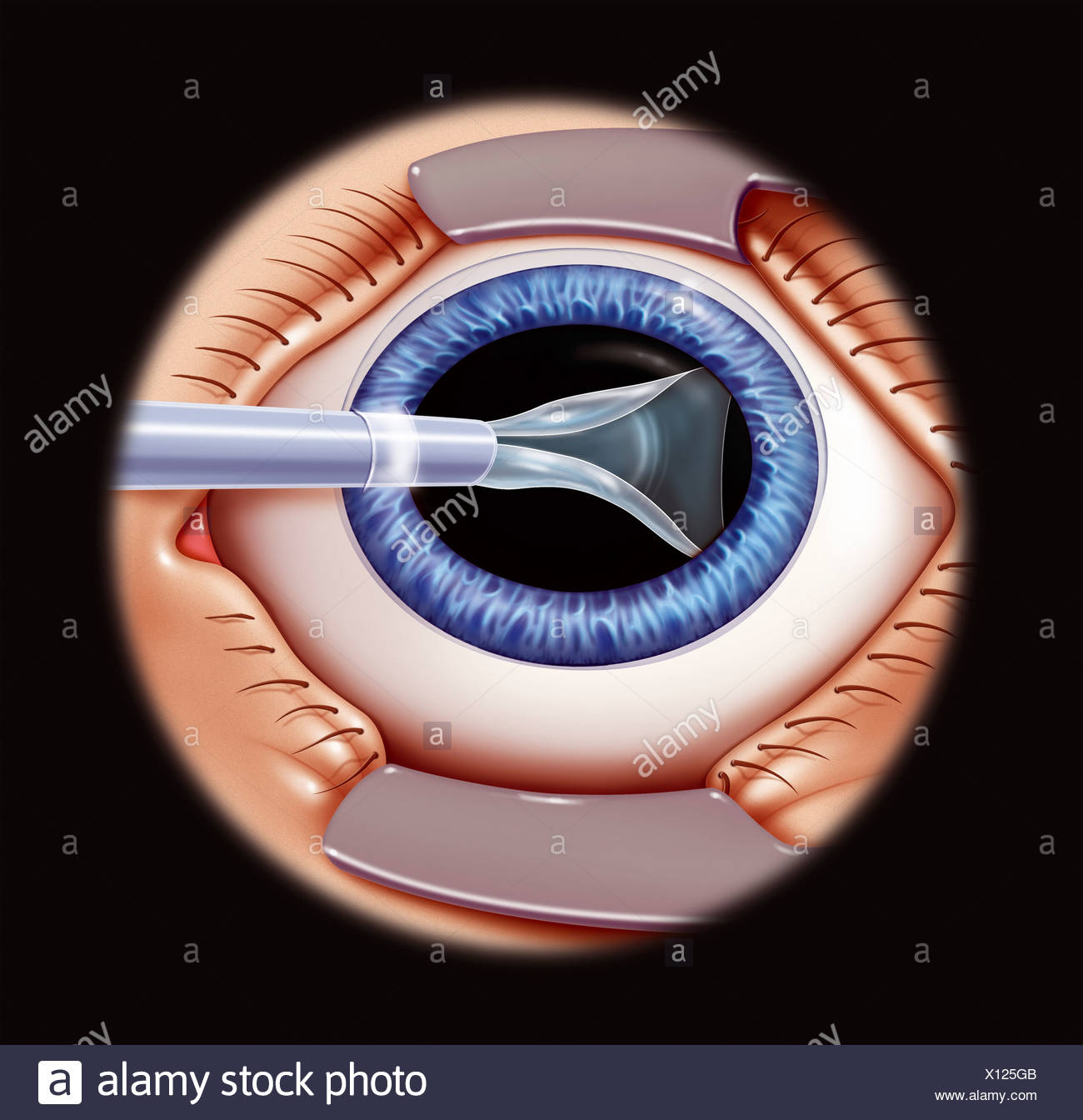 Anterior Chamber Lens High Resolution Stock Photography and Images - Alamy