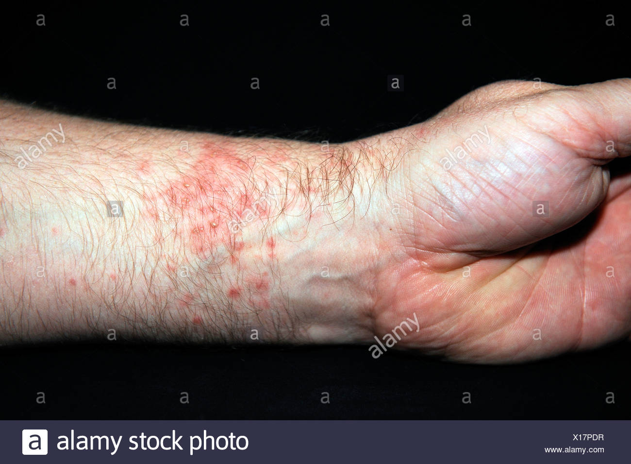 Urticaria Rash High Resolution Stock Photography and Images - Alamy