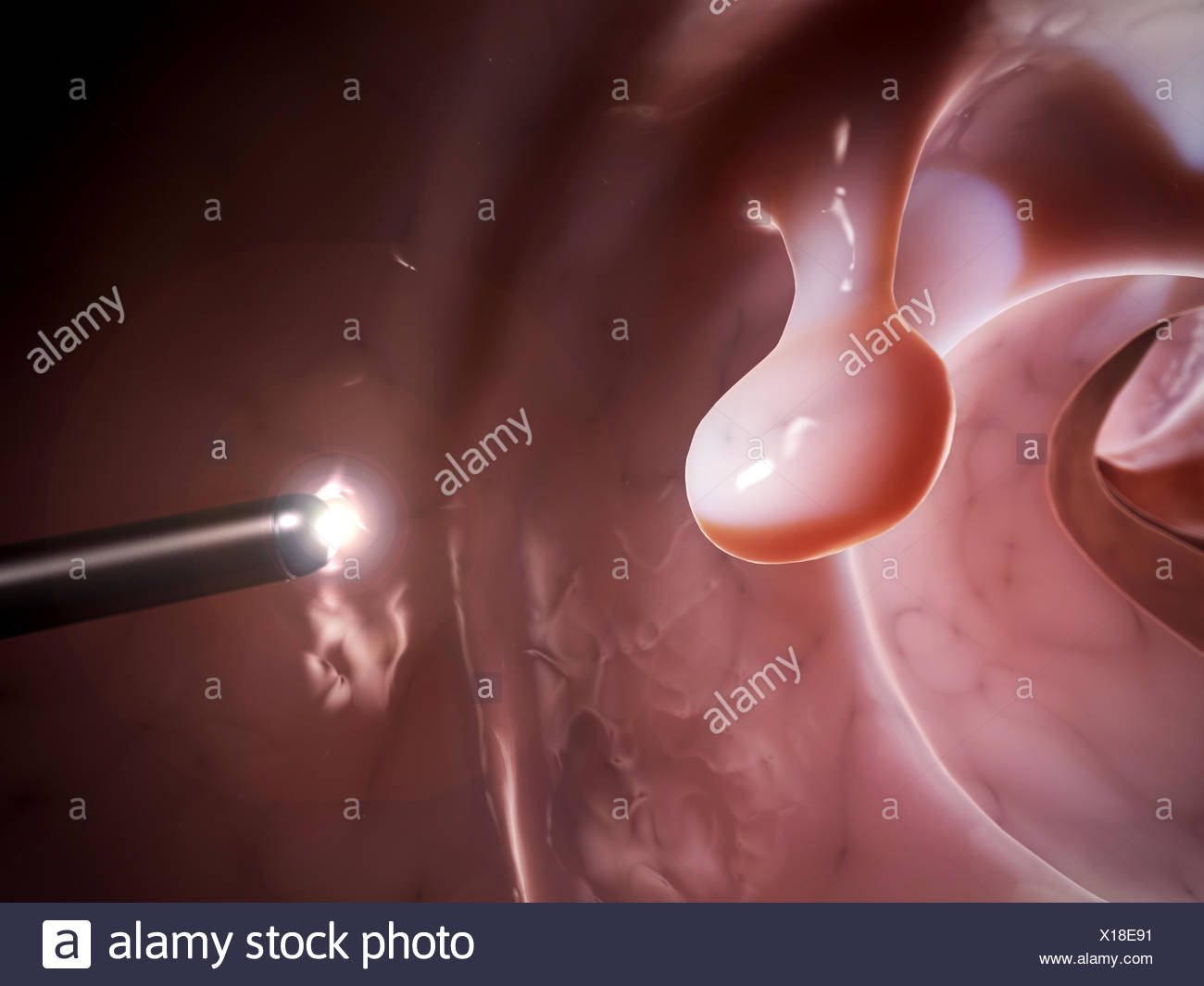 Colonoscopy Virtual Stock Photos & Colonoscopy Virtual Stock Images - Alamy
