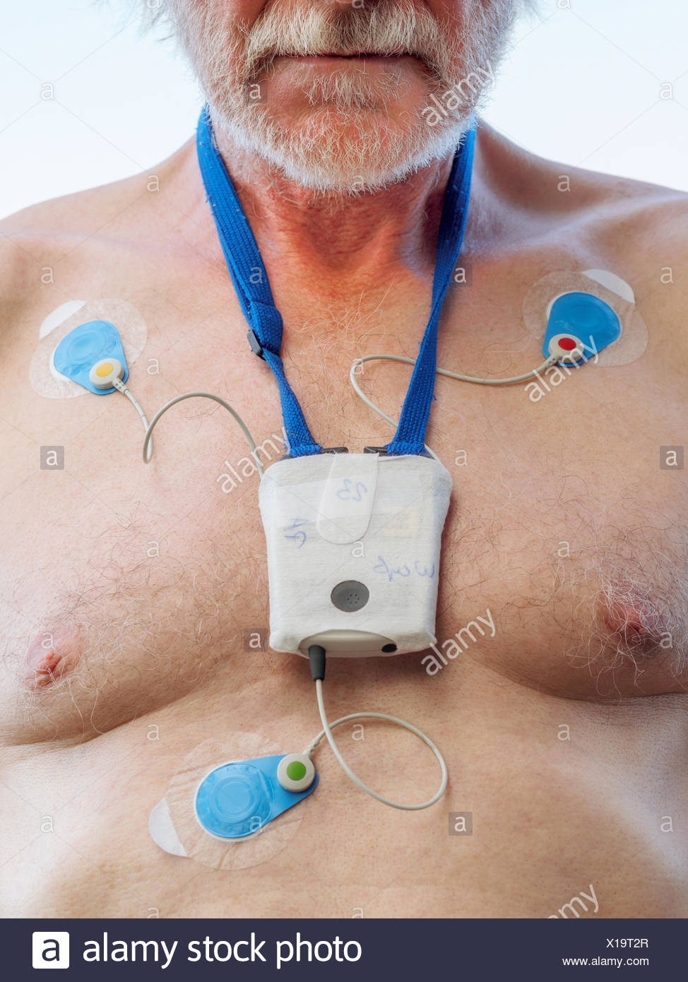 Arrhythmia On An Ecg High Resolution Stock Photography and Images - Alamy