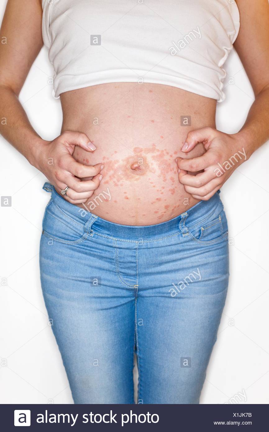 Irritation Rash Stock Photos & Irritation Rash Stock Images - Alamy
