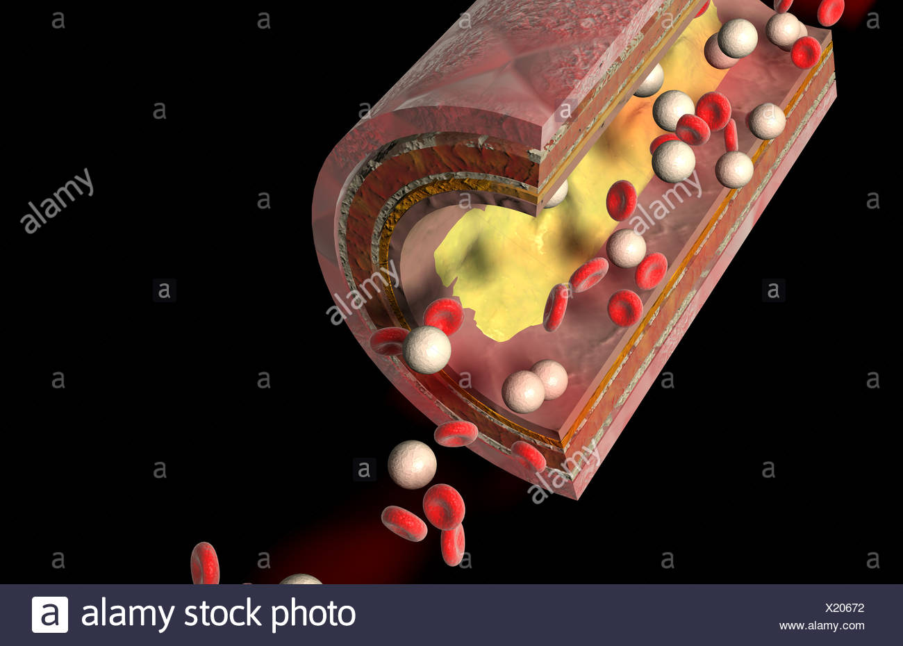 Atheromatous High Resolution Stock Photography and Images - Alamy