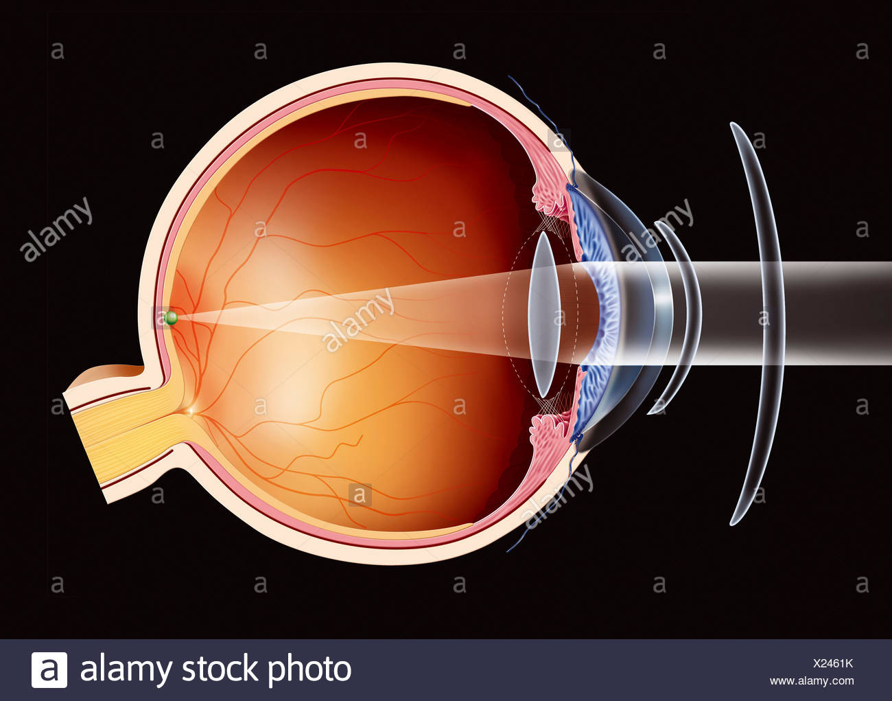 Intraocular Lenses Stock Photos & Intraocular Lenses Stock Images - Alamy