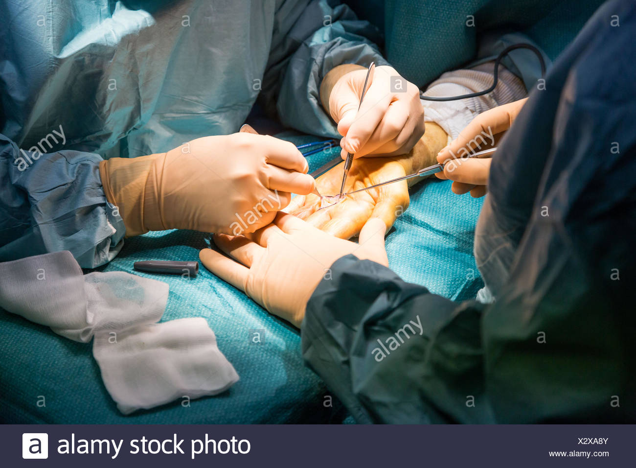 Dupuytrens Contracture Hand Surgery High Resolution Stock Photography ...