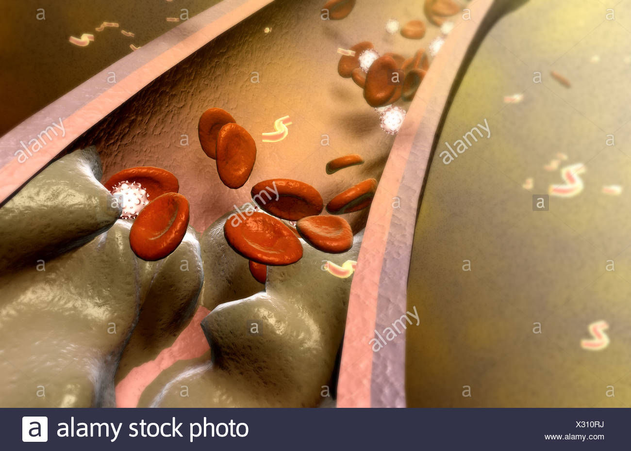 Atheroma High Resolution Stock Photography and Images - Alamy