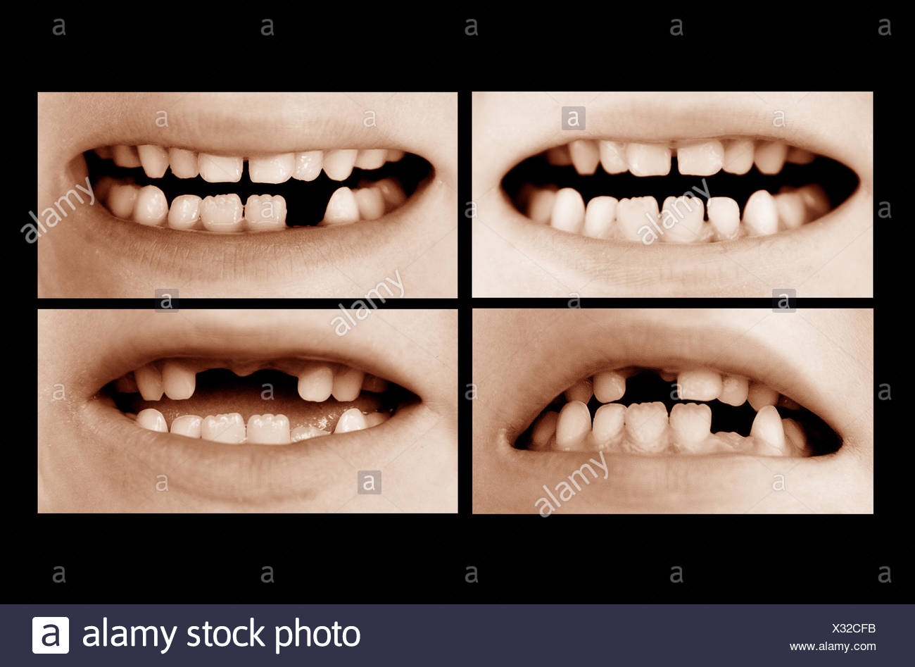 Milk Teeth High Resolution Stock Photography and Images - Alamy